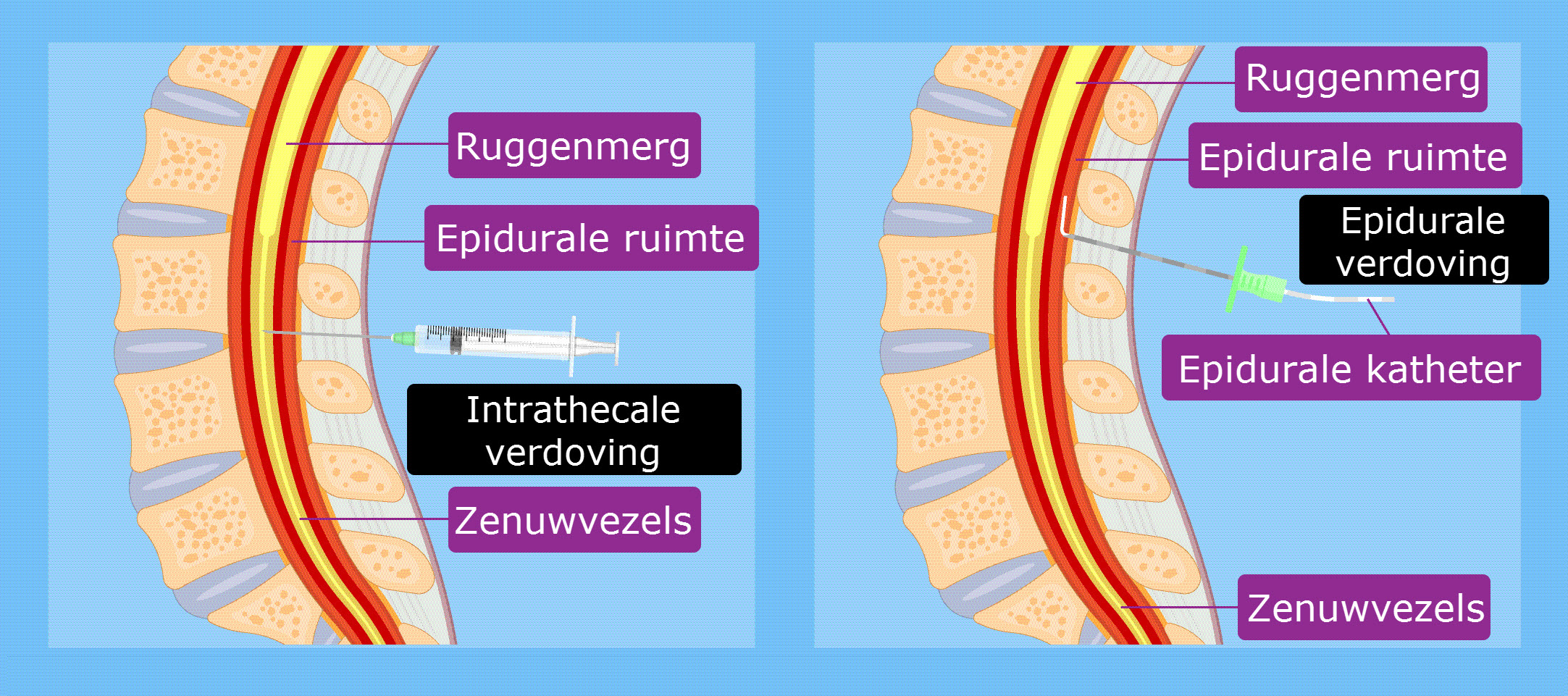 Slingeland Ziekenhuis - patiëntfolder: Langdurige pijnbestrijding via ...