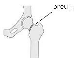 Slingeland Ziekenhuis - patiëntfolder: Gebroken heup