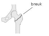 Slingeland Ziekenhuis - patiëntfolder: Gebroken heup