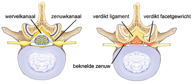 Slingeland Ziekenhuis - patiëntfolder: Operatie aan de rug: rughernia ...