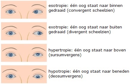 Slingeland Ziekenhuis - patiëntfolder: Scheelzien